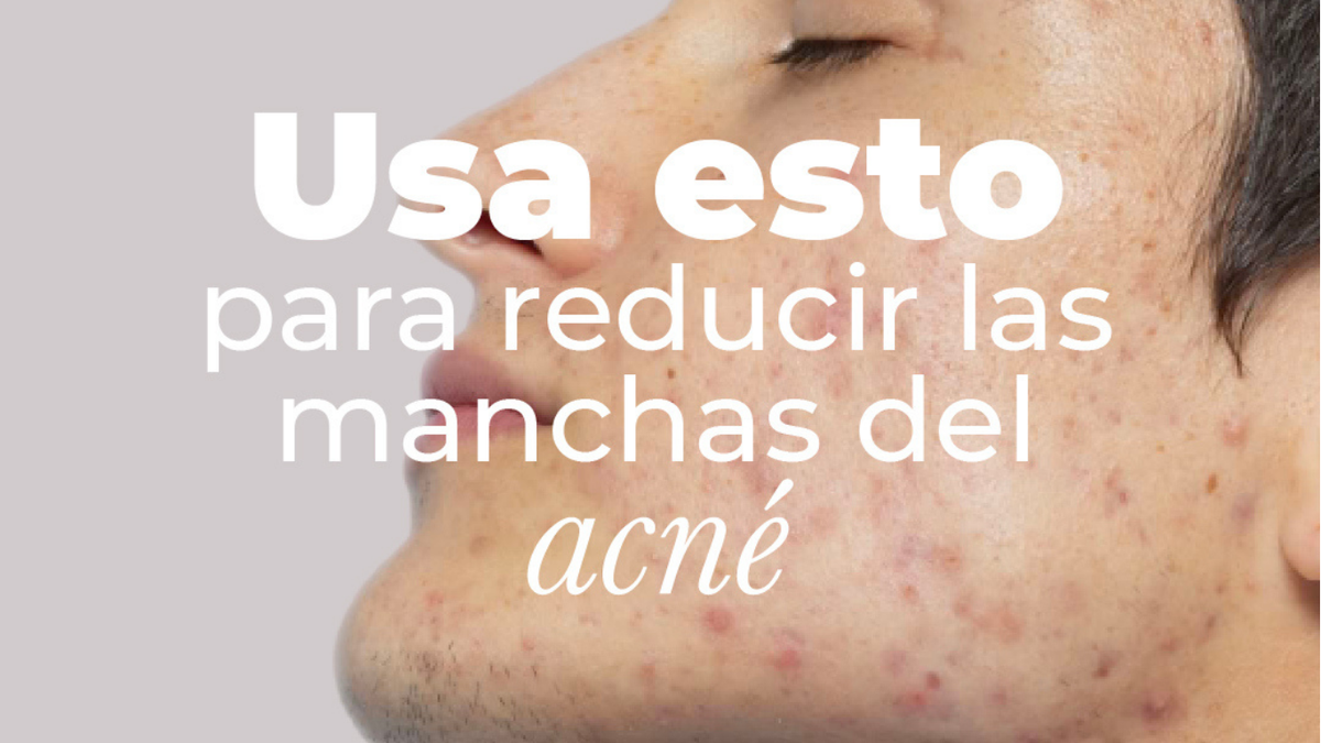 Acné de adulto: ingredientes clave para mejorar las marcas en la piel ...